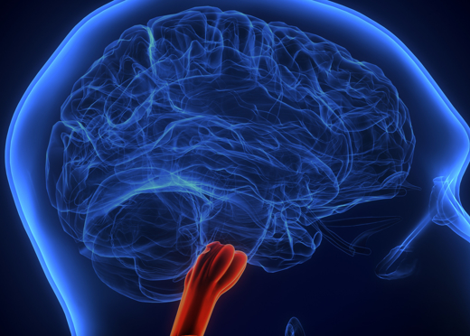 İnme (Felç) Nedir, Belirti ve Tedavi Yöntemleri Nelerdir? | Medical Point